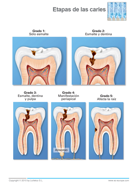 Etapas de las Lesiones de Caries :: Clínica Dental S&G